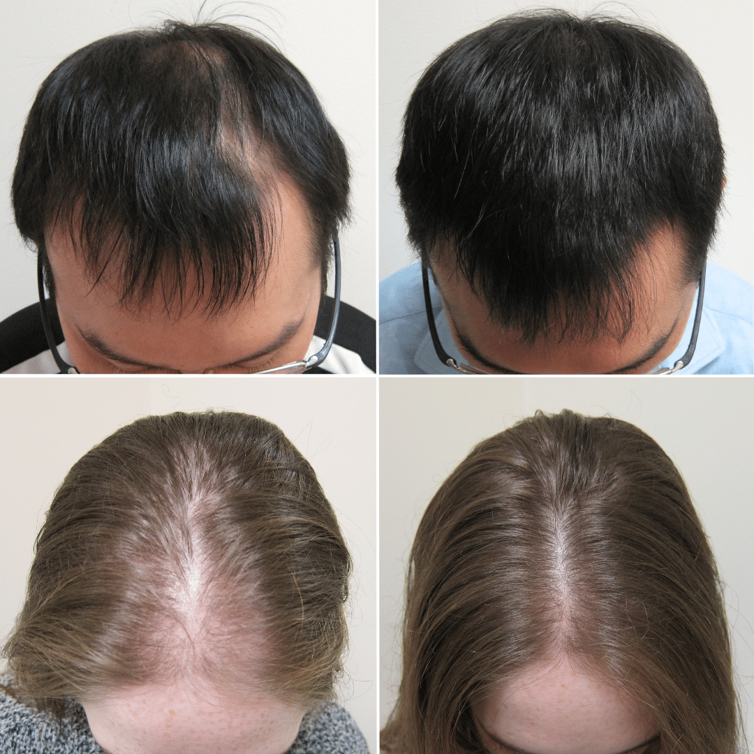 Hair Loss Clinics Melbourne, Australia | Bioscor AU